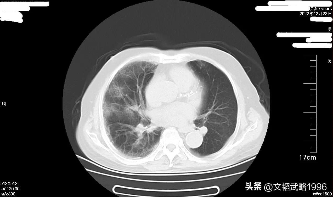 Viral lung has progressed into "white lung", and the treatment effect ...