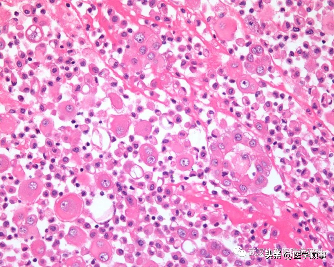 Cytopathological serous cavity effusion cytology specimen - iNEWS