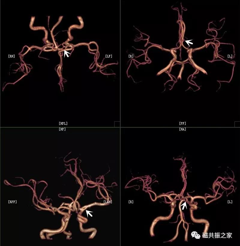 Common Normal Variations of Intracranial MRA - iNEWS
