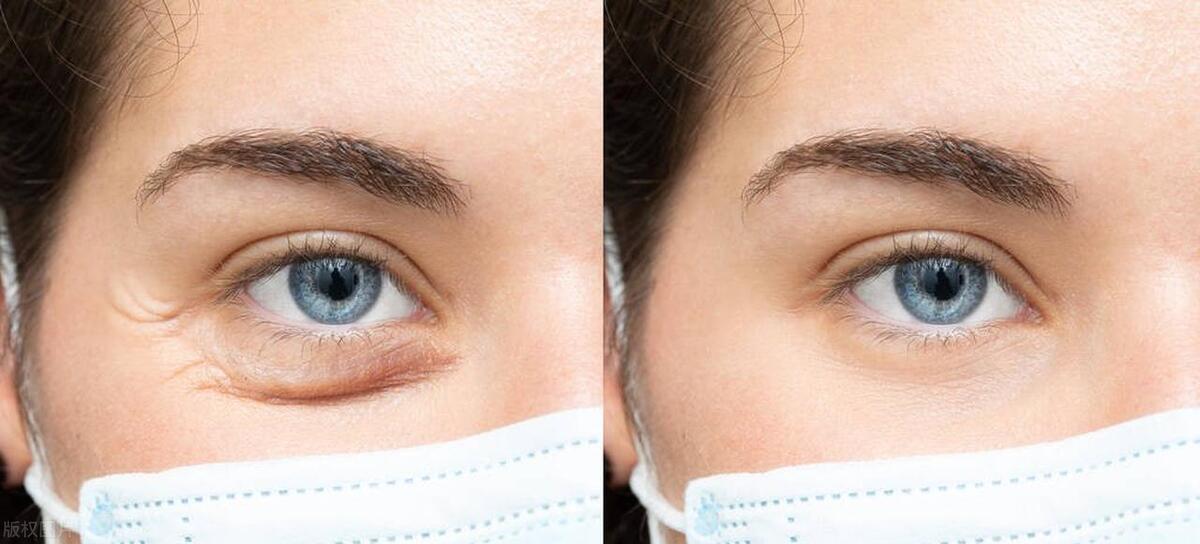 Beijing Lihe Eye Bag Removal: Surgical Process and Precautions for ...