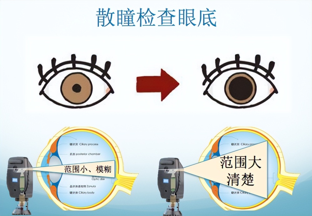 Why should mydriasis be dilated before LASIK surgery? - iNEWS