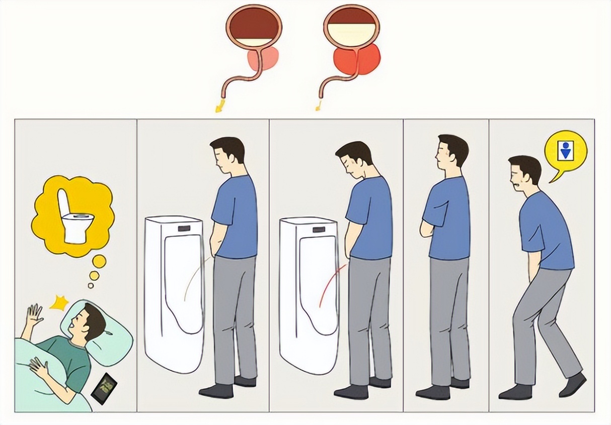 Thin thread, interrupted urination? Don't pass the urethra! A ...