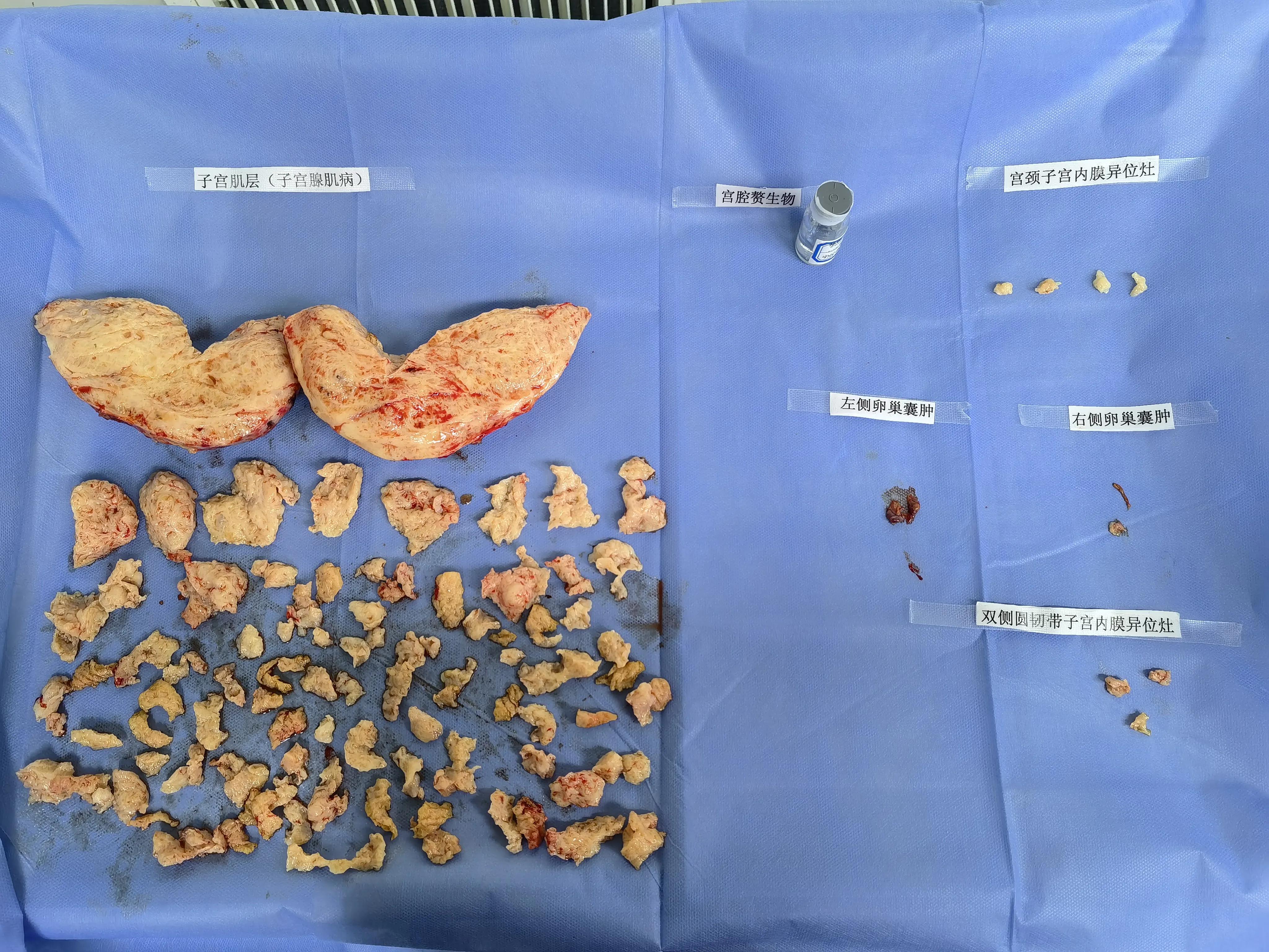 Ms. Xu from Wuhan, 49 years old, suffered from adenomyosis for 17 years ...