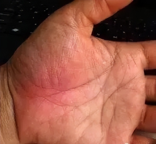 Traditional Chinese Medicine: The long-lost thenar diagnosis method ...
