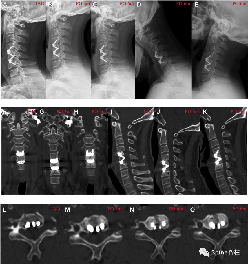 Professor Liu Hao's team from West China Hospital: Anterior cervical X ...