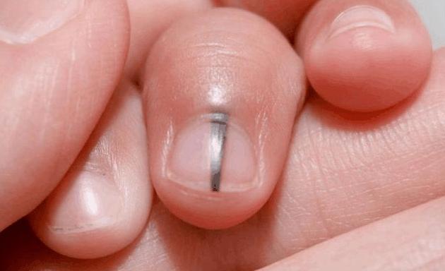 Vertical lines on nails are a sign of disease?About the secret of nails ...