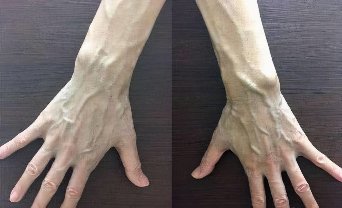 Some people have "blue veins protruding" on their arms, but some people ...