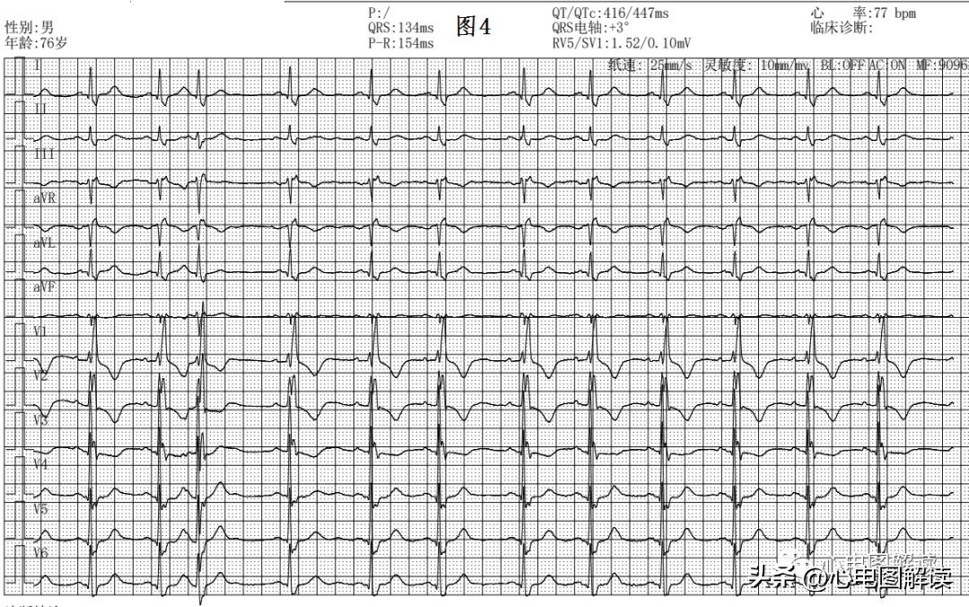 Complete right bundle branch block in 6 cases - iNEWS