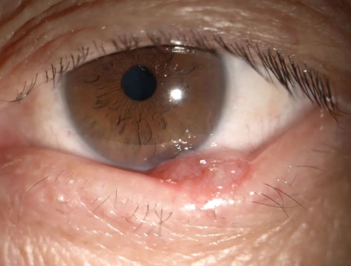 Shocked!A 50-year-old uncle has a small pimple on his eyelid, but it is ...