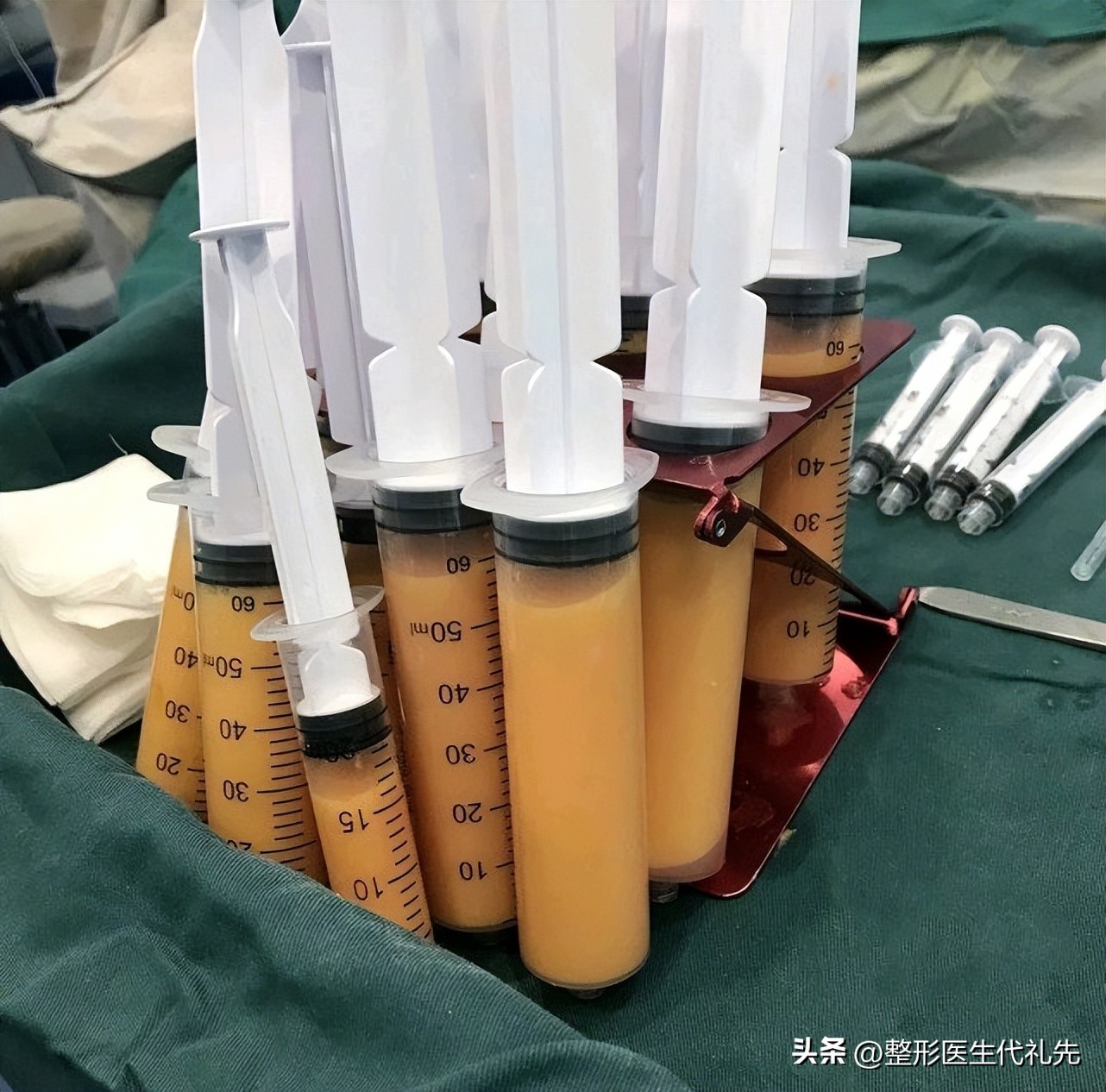 Facial fat filling not only makes the shape more beautiful, but also ...