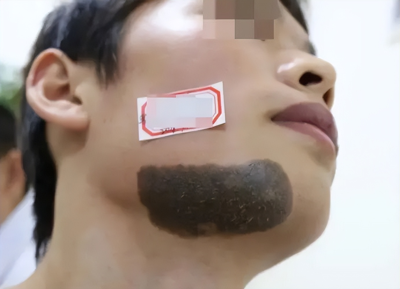 Beware of black hairy moles, beware of malignant transformation - iNEWS