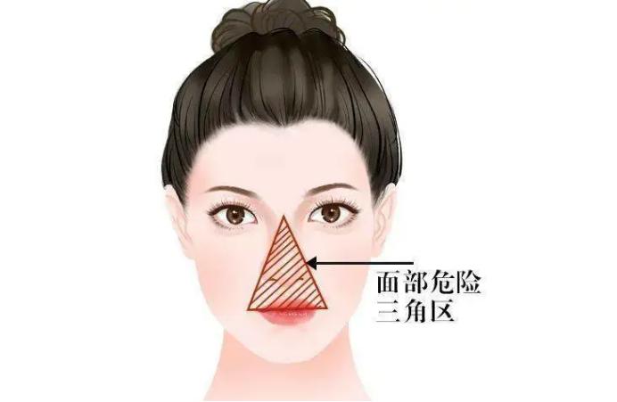 Do not squeeze the acne in this area, be careful of serious infection ...
