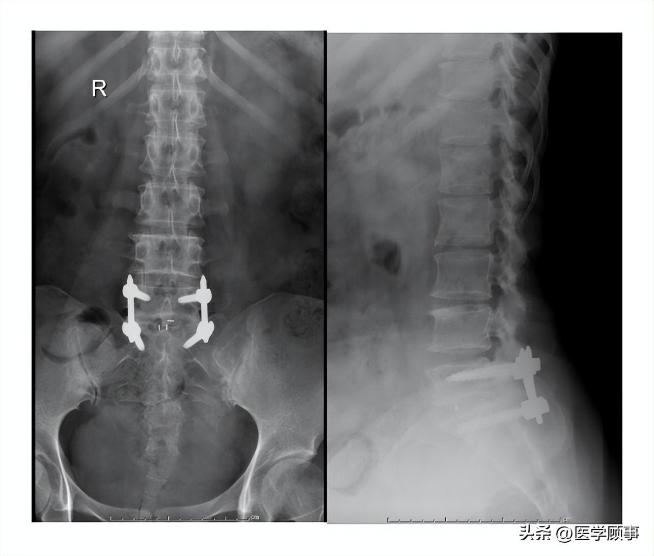 Minimally Invasive Lumbar Fusion (UBE-LIF) - iNEWS