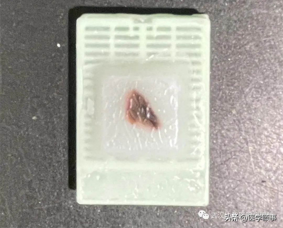 Cytopathological serous cavity effusion cytology specimen - iNEWS