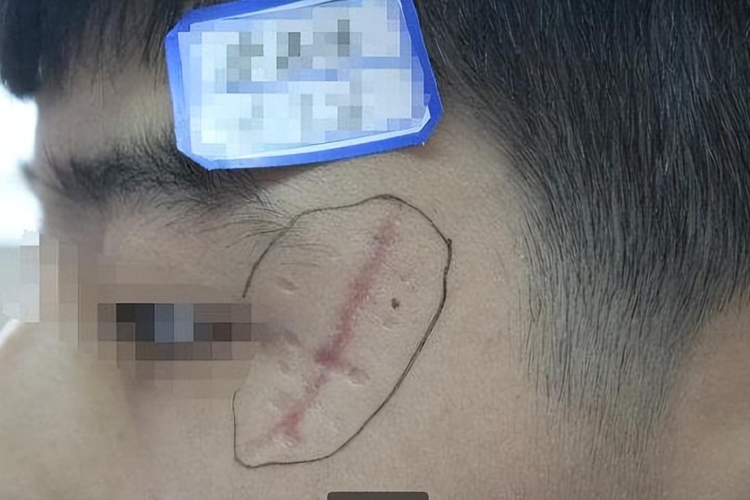 There are 7 types of common scars, which one are you? - iMedia