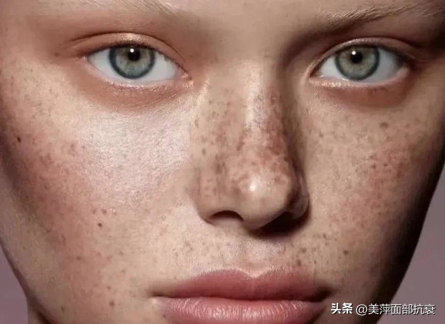 How do freckles form, and how can they be removed safely? - iMedia