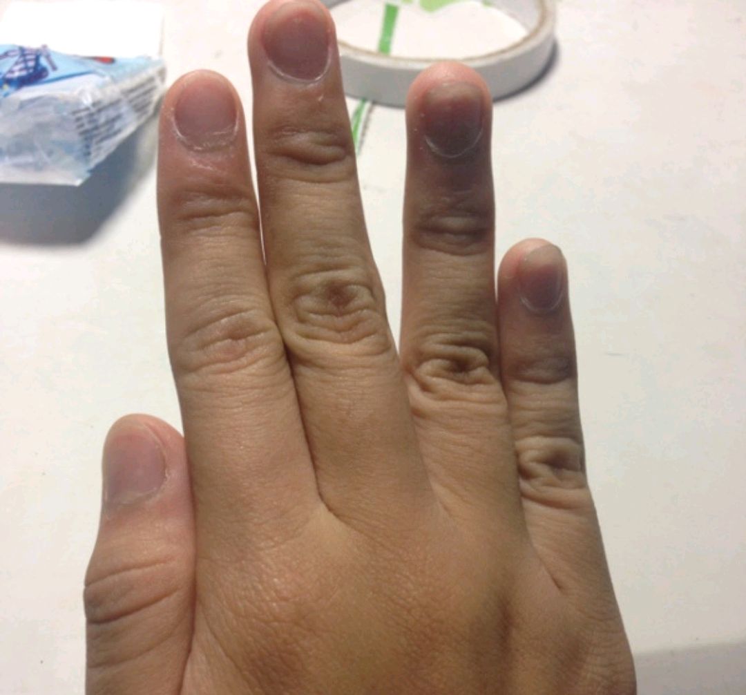 There is only one lung in the human body. If the lung is not good, it ...