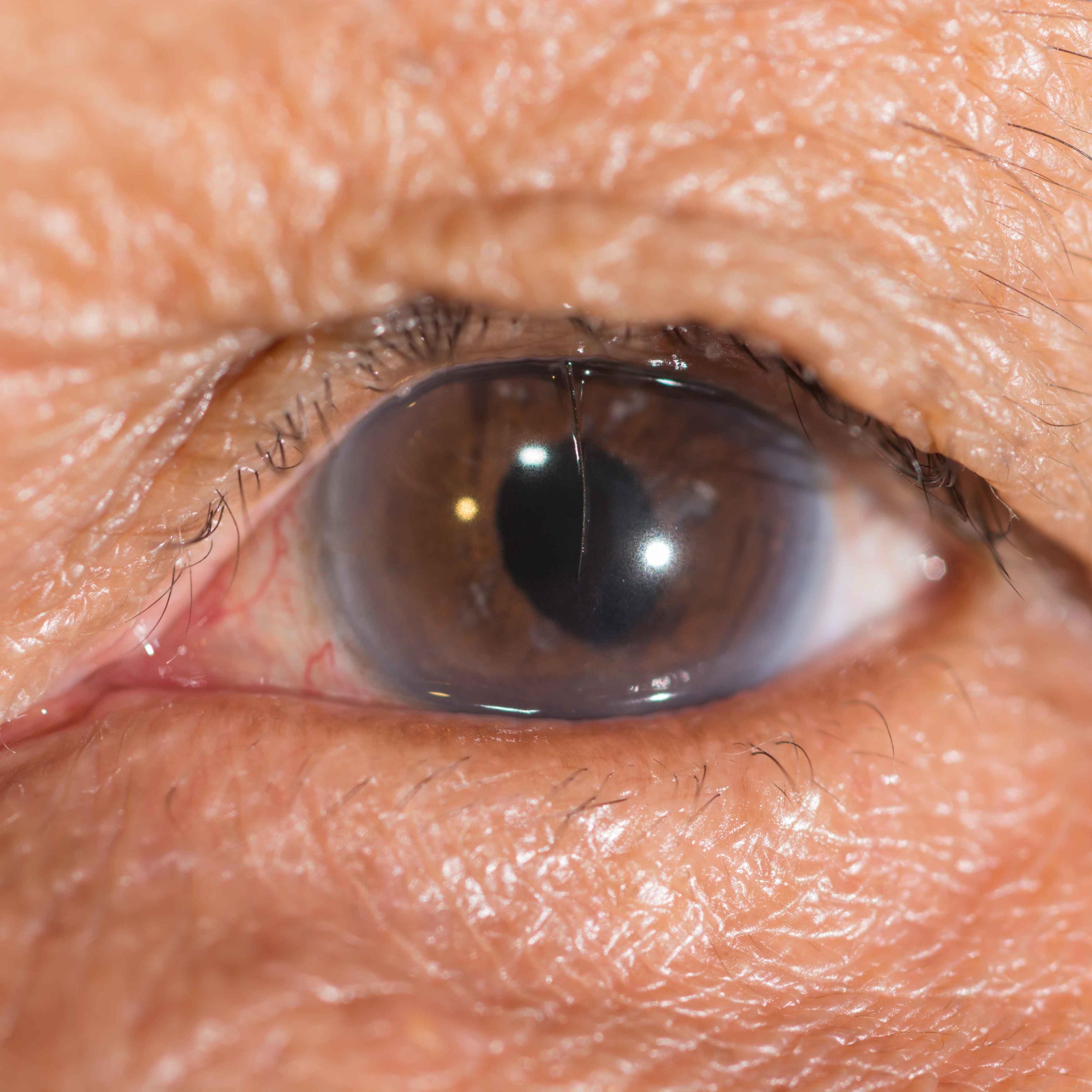 An action that often relieves eye fatigue, which may cause the eyeball ...