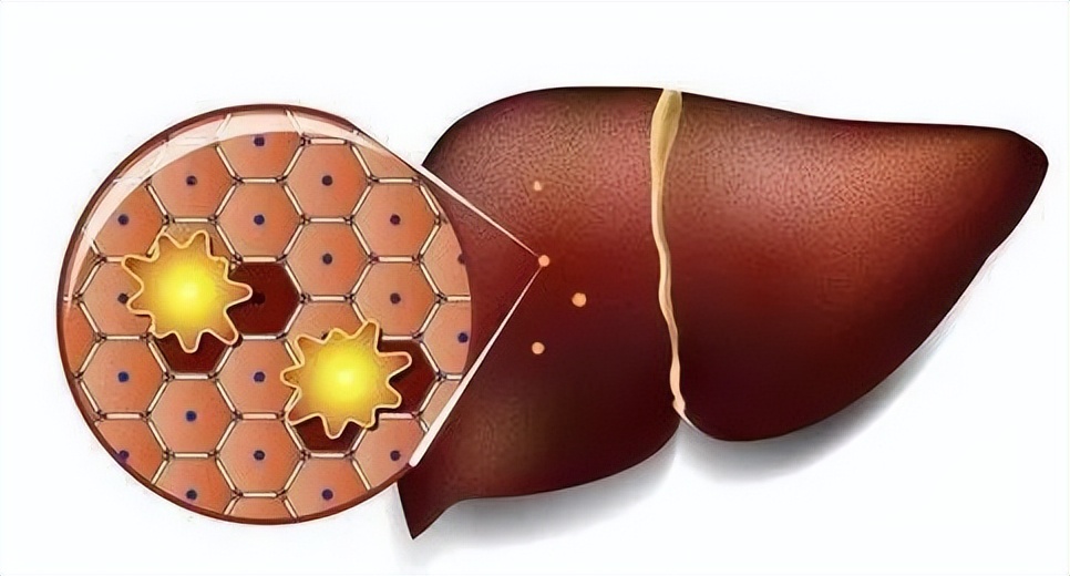 A bad liver can cause multiple itching symptoms all over the body, the ...