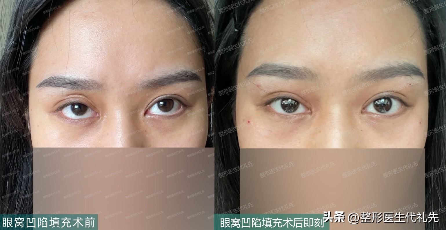 Sunken eye sockets are the "traitors" of age, choose orbital septum fat ...