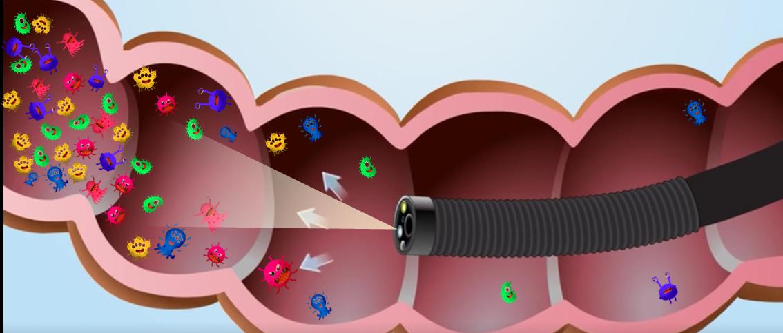 Doing a colonoscopy - the impact of "colon cleansing" on the intestinal ...