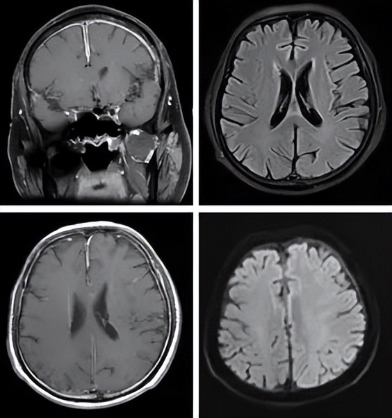 Headache, fever, pulmonary nodules and "extensive dura mater ...