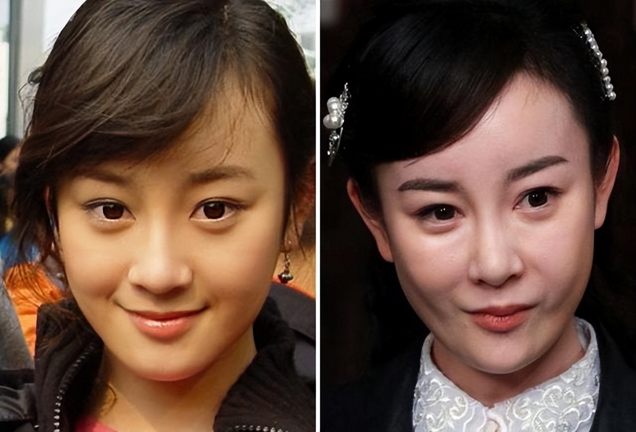 The faces of several celebrities with excessive plastic surgery are very stiff, and there are no ...
