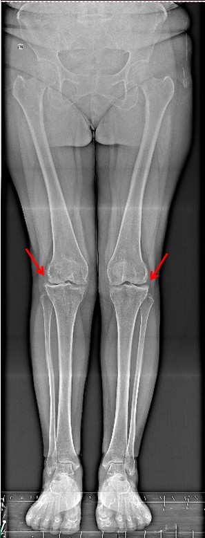 Common Types of Surgery for Total Knee Replacement (2) - Valgus Knee ...