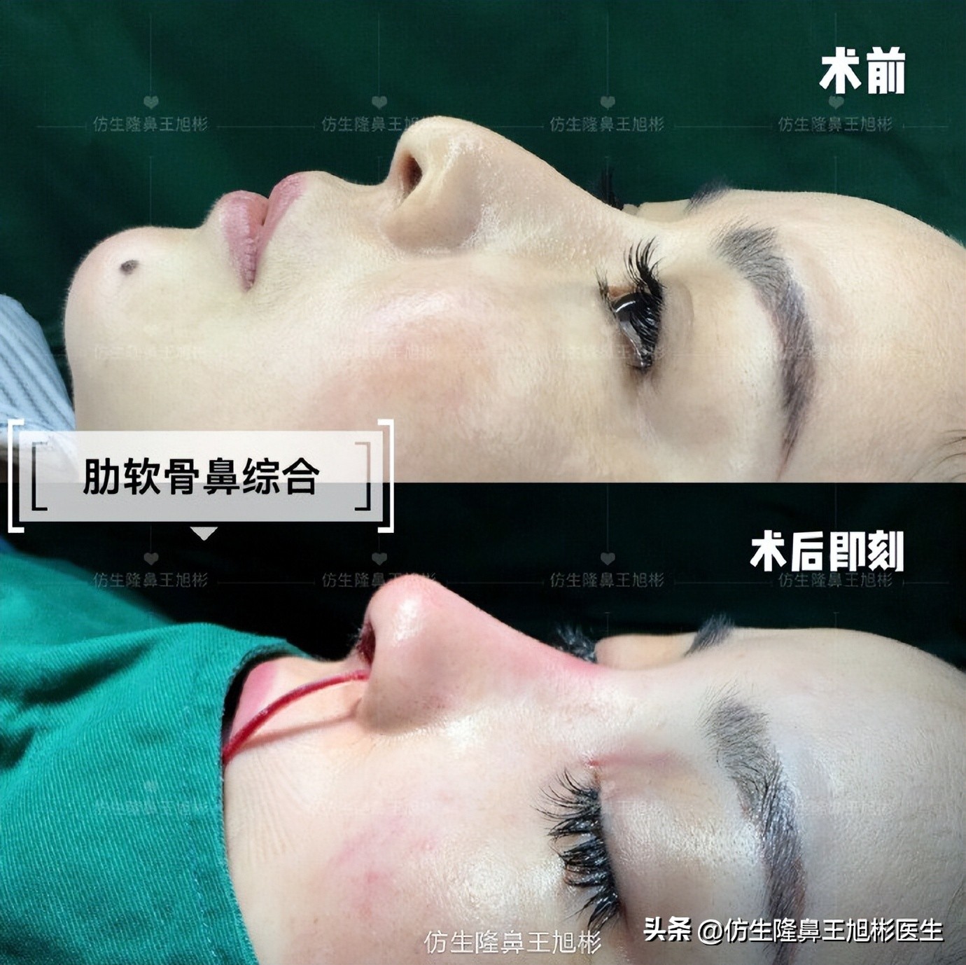 "Hook nose" is fierce and old, how to correct it? - iNEWS