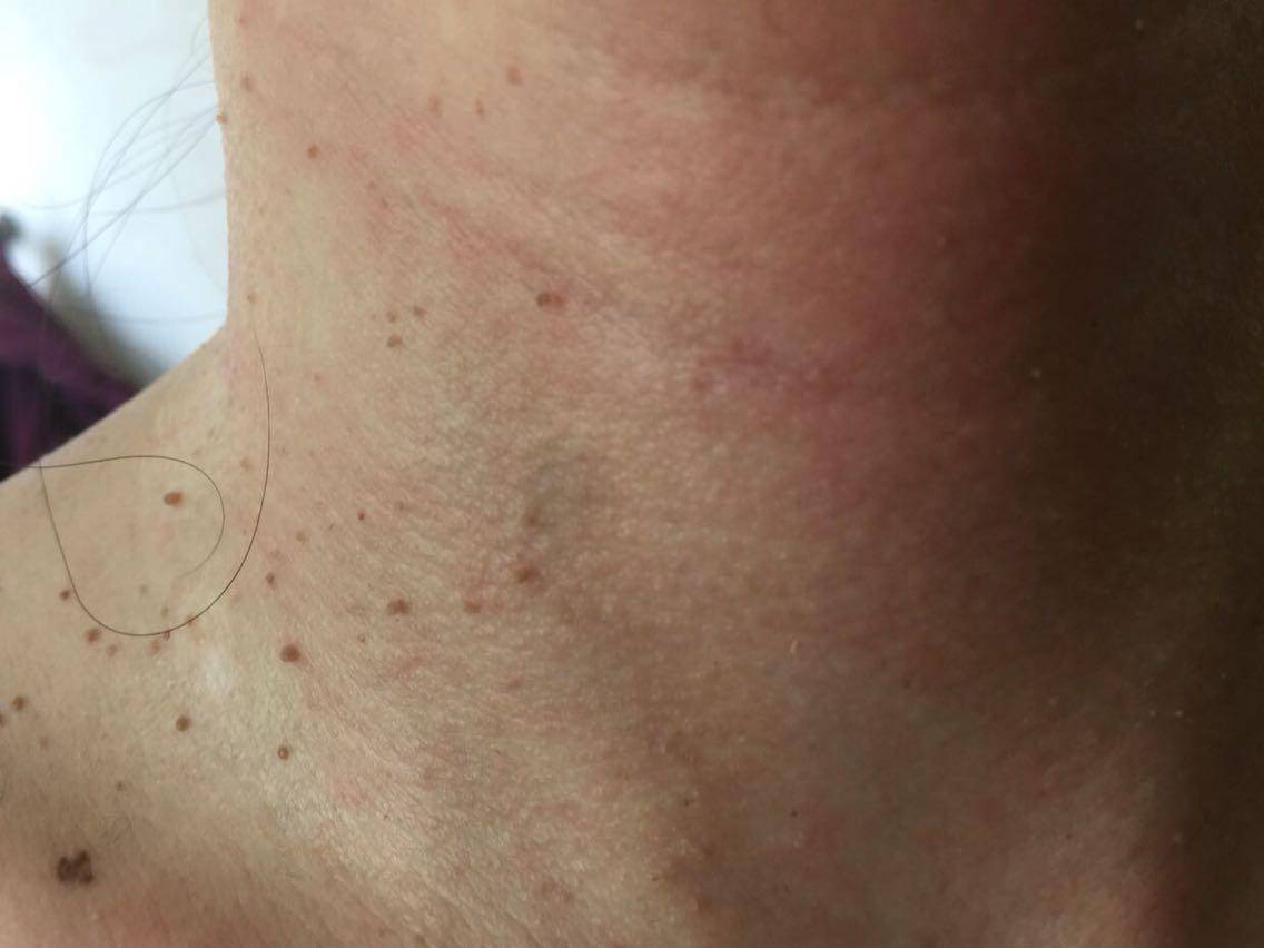 What is the reason for the "small meat grains" on the neck? Do I need ...