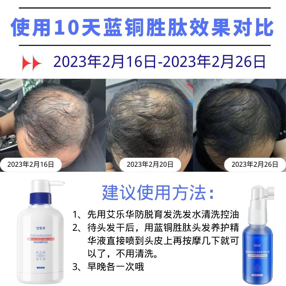 The main causes and solutions of hair loss in men - iMedia