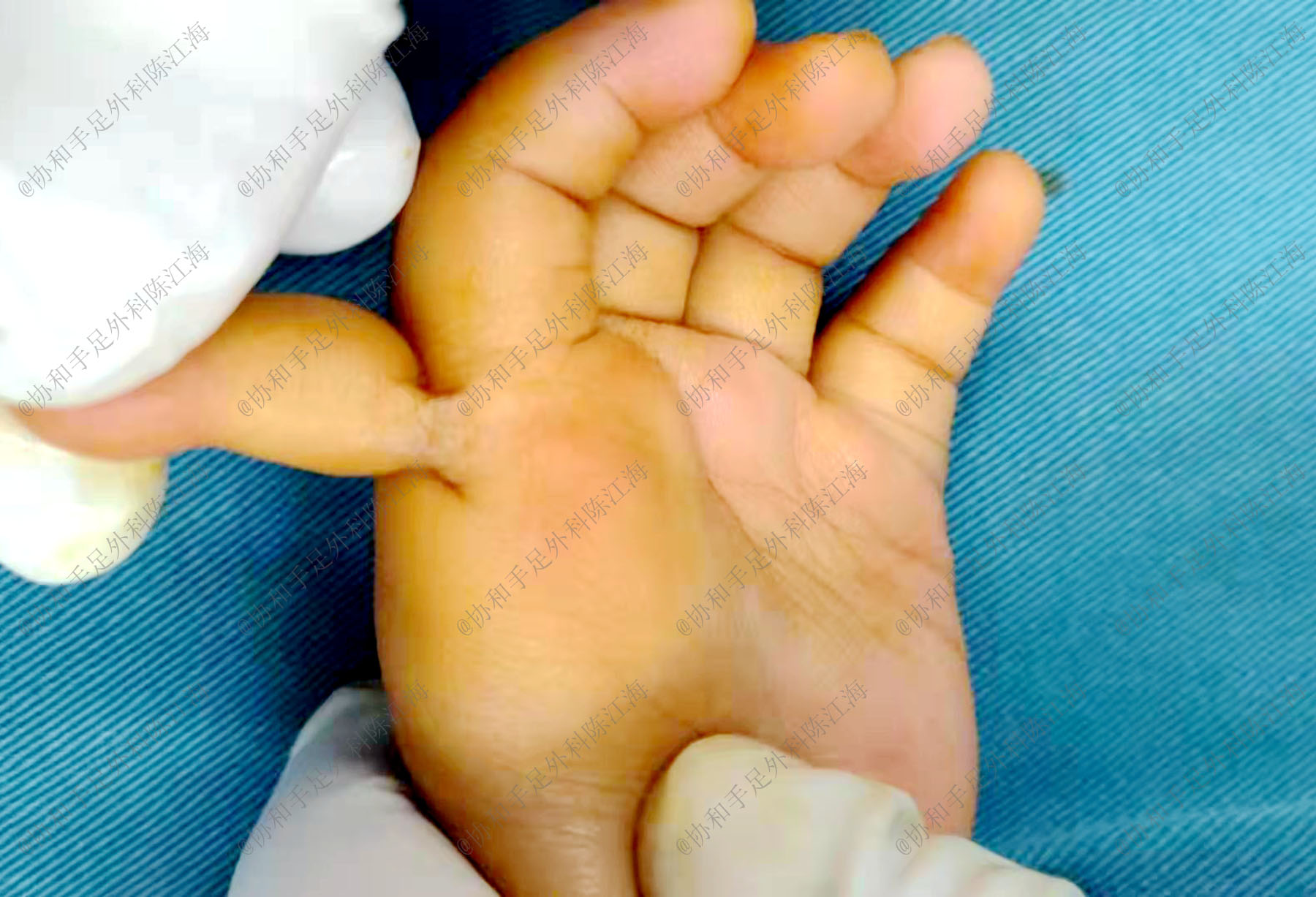 The baby's thumb is weak and has no metacarpal bones. Parents should be ...