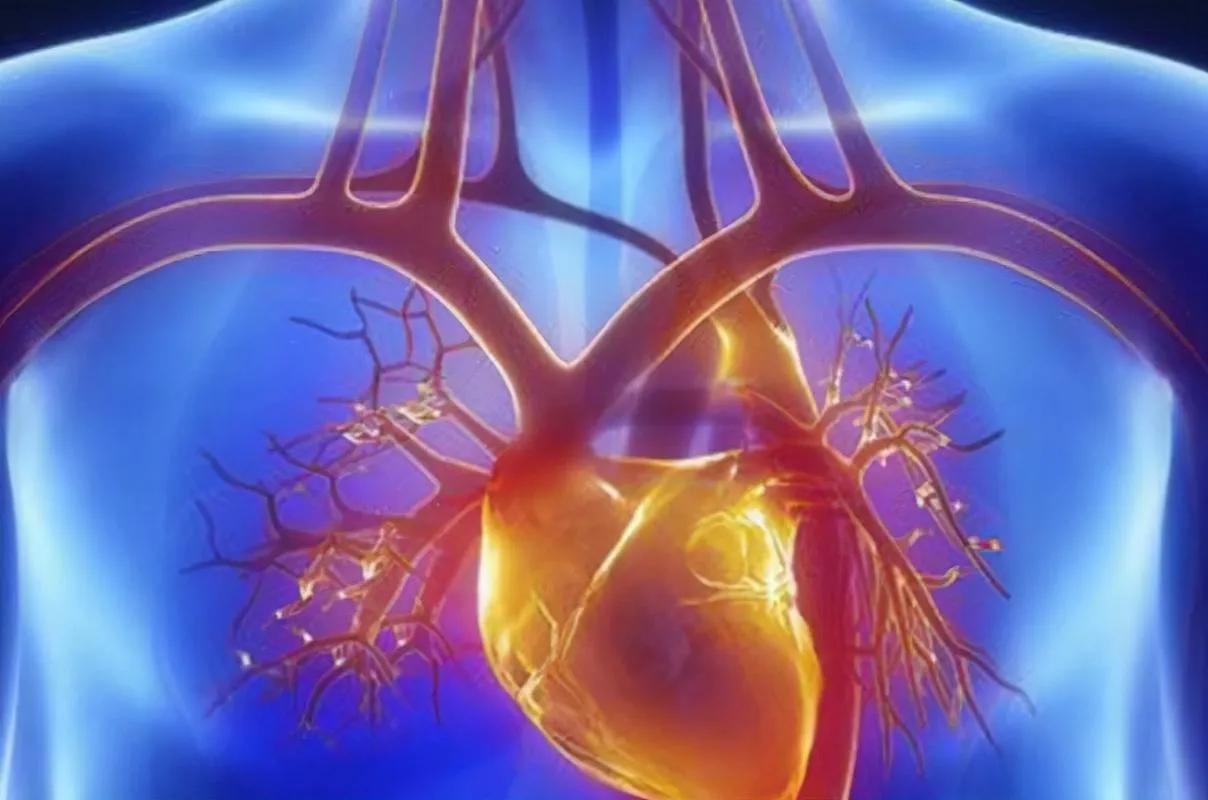 heart rupture due to myocardial infarction - iNEWS