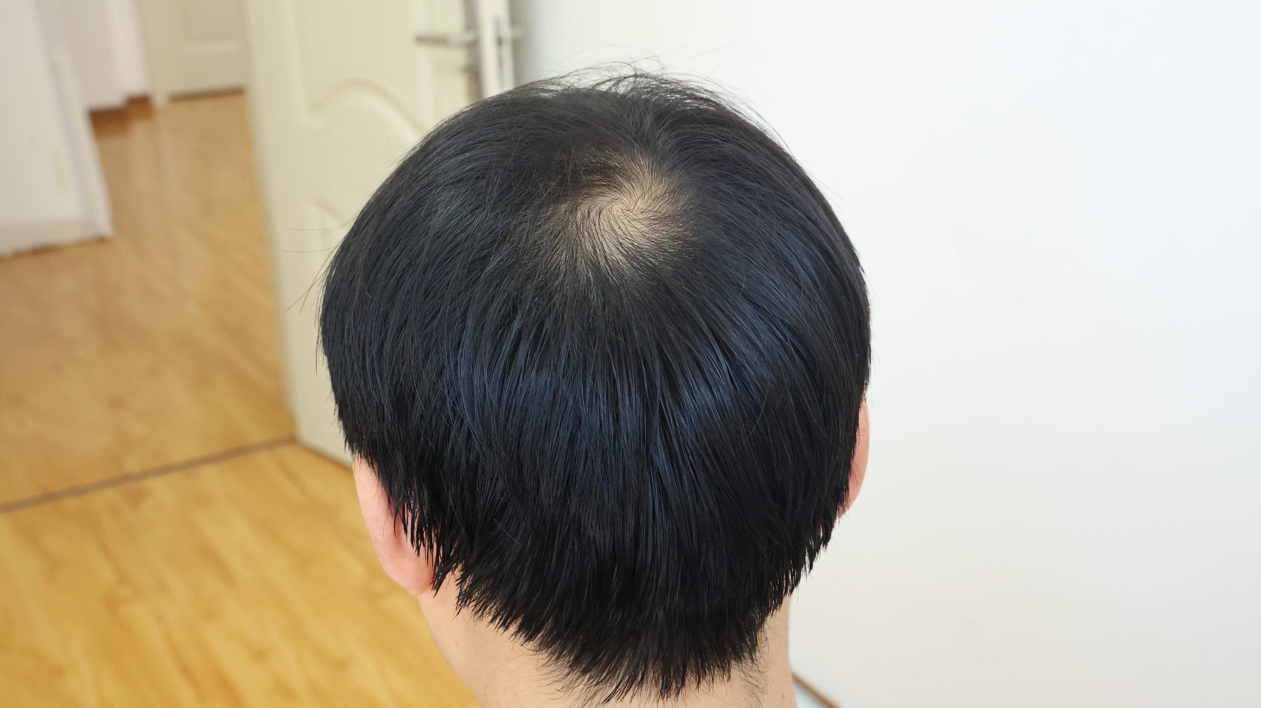What are the common types of "baldness"? The emergence of baldness ...