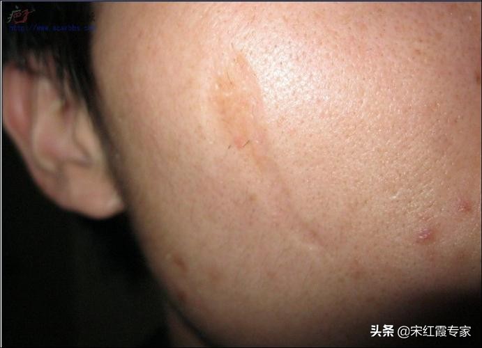 How to fix sunken scars on the face - iMedia