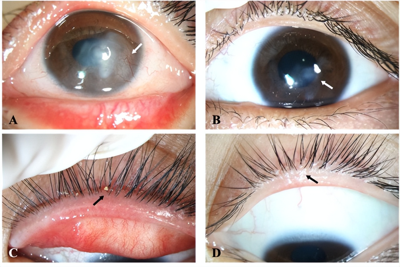 Low-Intensity Intense Pulsed Light Therapy Effectively Improves ...