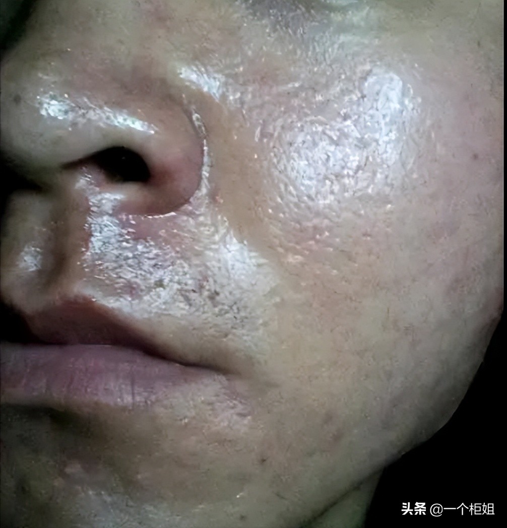 The pores on the nose are large, and yellow millet grains can be ...