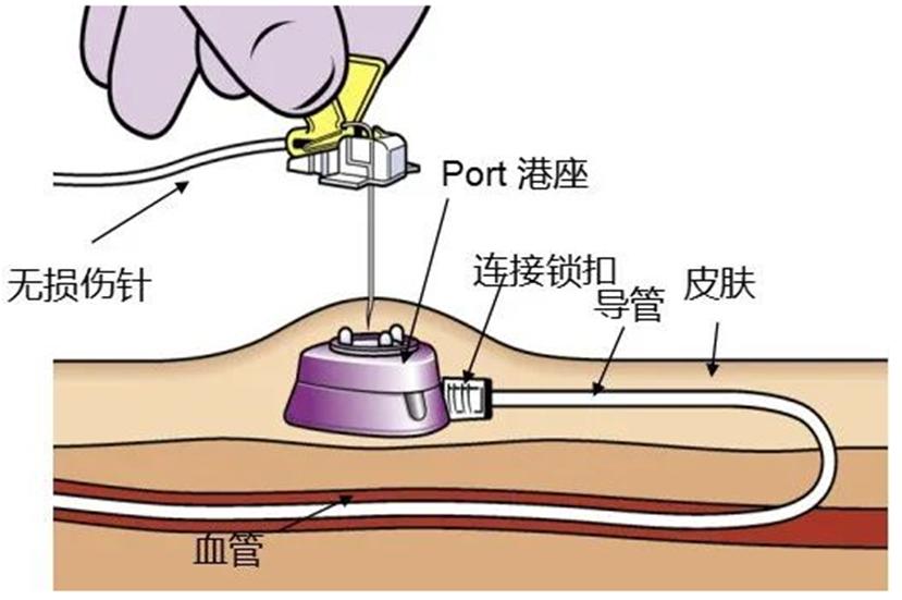 Infusion is no longer "simple", new technology meets medium and long ...