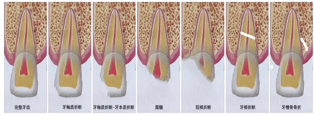 Dental Adventures (Episode 7) The permanent tooth was bruised - iNEWS