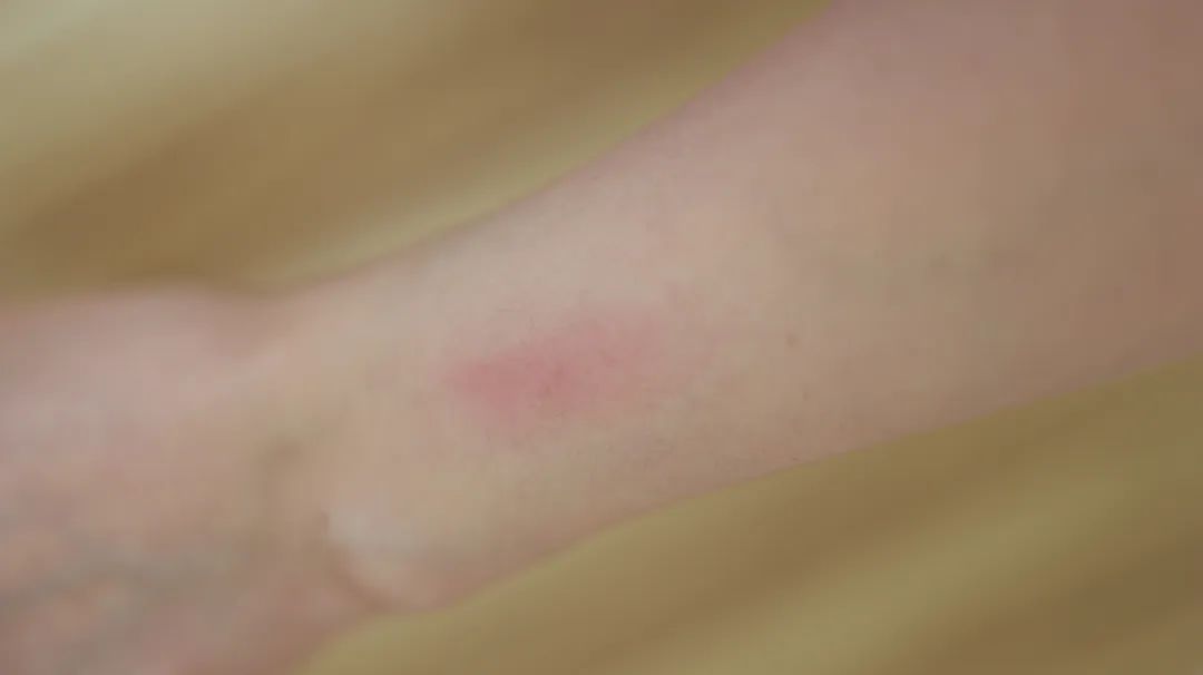 Skin Scratches: What are some tips for protection?Mastering these 3 ...
