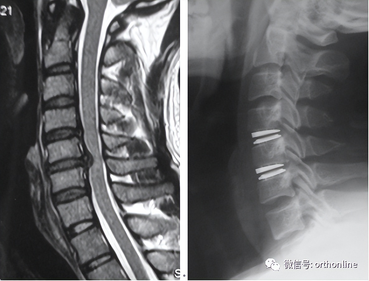 Current status and future of cervical artificial cervical disc ...