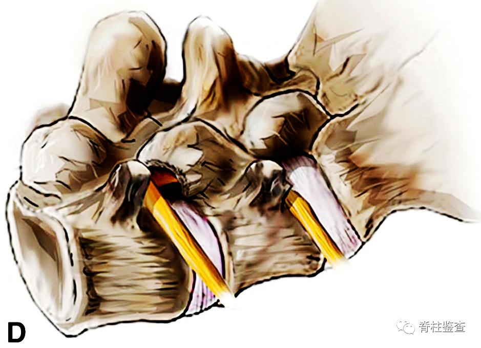 Percutaneous endoscopic lumbar foraminotomy decompression: what to do ...