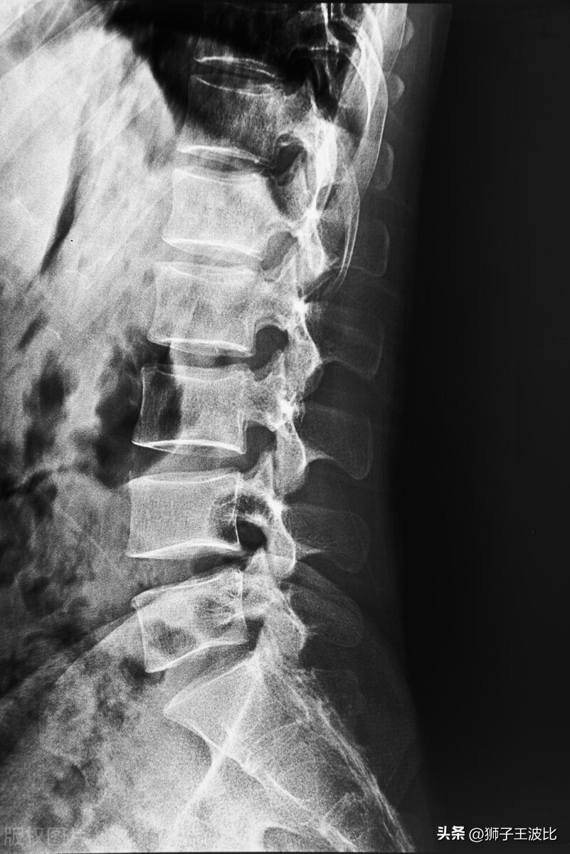 Lumbar muscle strain?Lumbar disc?Stupid can't tell?Lumbar disc ...