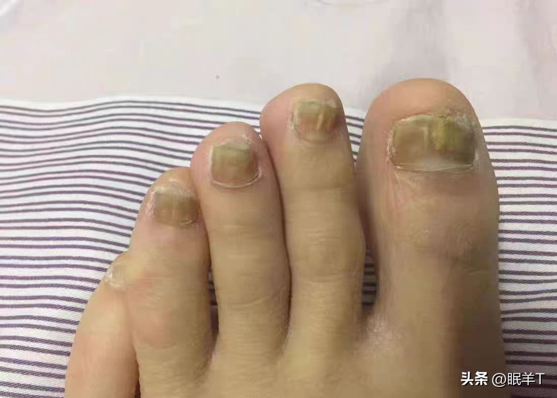 Got nail fungus! Teach you to develop ruddy and shiny nails! Come and ...