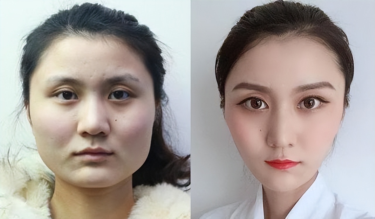 Is bone reduction plastic surgery very risky? The sequelae of Li Bingbing and Yang Mi's bone ...