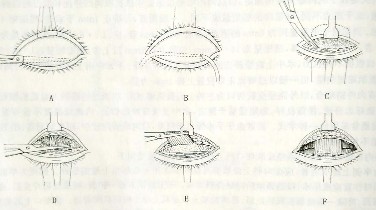 Is levator muscle a must in double eyelid surgery? - iNEWS