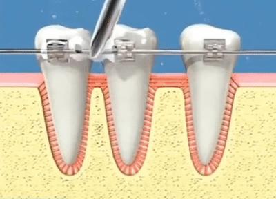 Bone buck teeth, open lips, chin retraction... Can adults correct their ...