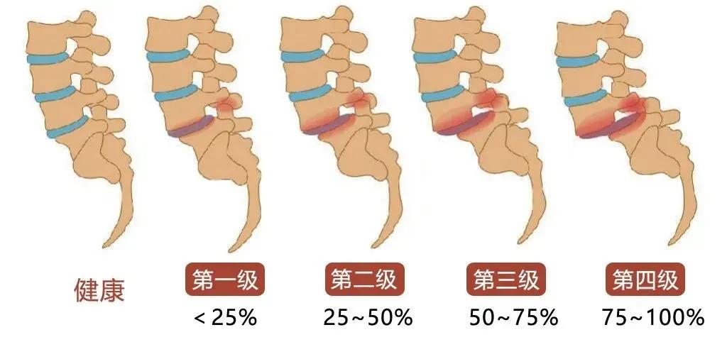 How is lumbar spondylolisthesis treated? - iNEWS