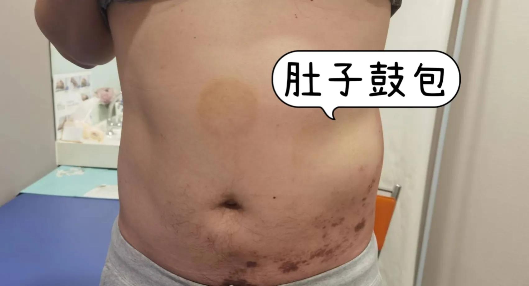 The shingles is cured, why is the belly bulging?——It turned out to be ...