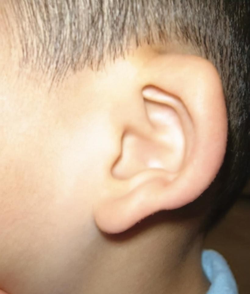 What are the characteristics of cupped ears? How can they be fixed? - iNEWS